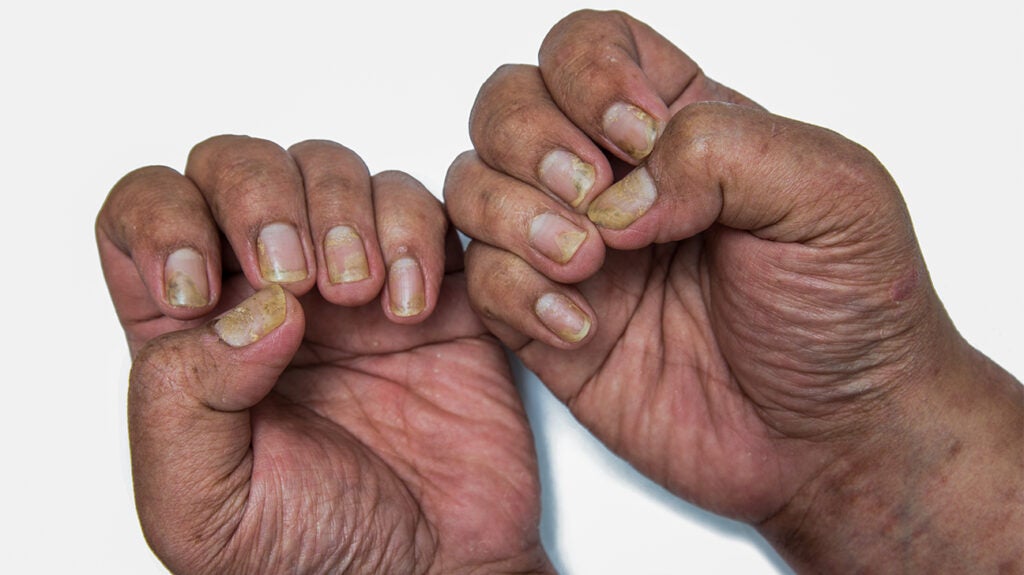 Psoriasis and psoriatic arthritis: What's the link?