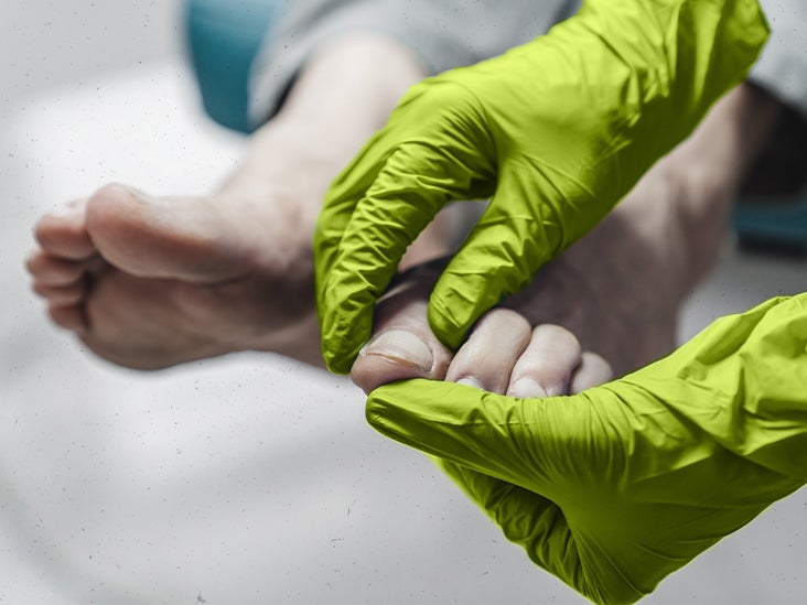 Psoriatic arthritis and nails: Changes and treatment