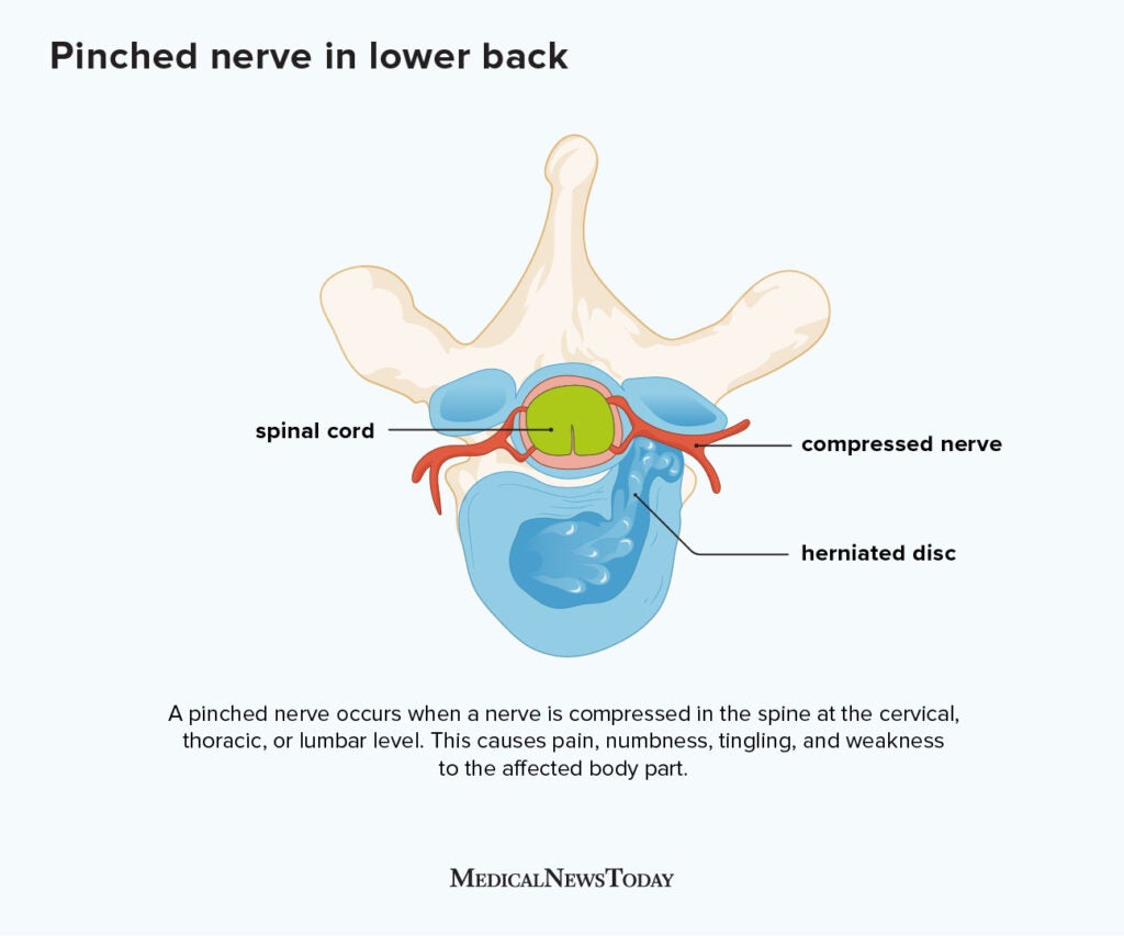 Pinched nerve in lower back: How to tell and more