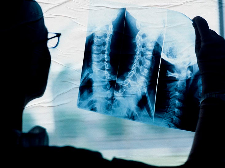 Spinal stroke: Symptoms, causes, recovery, and prognosis