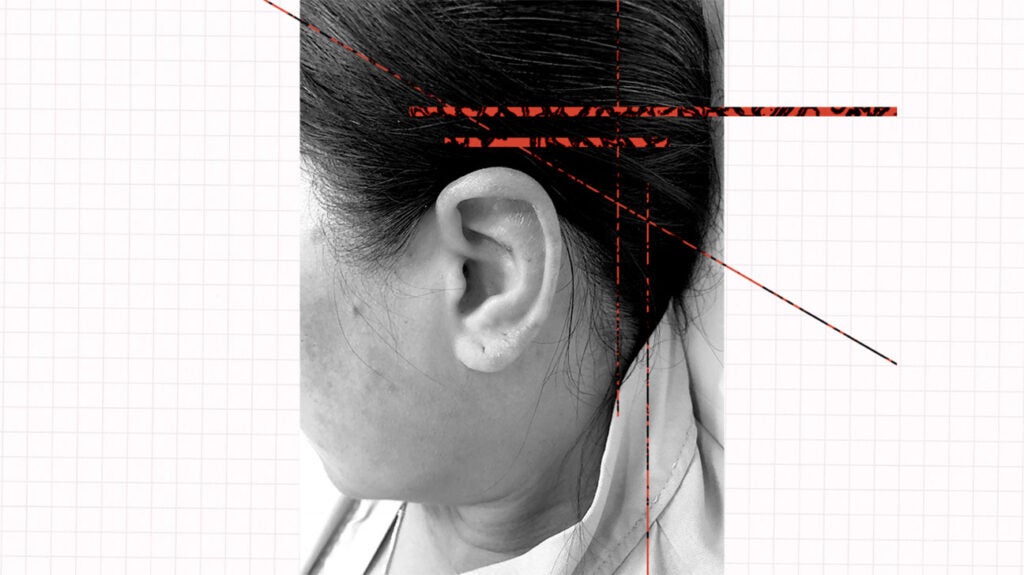 Relapsing polychondritis: What are early symptoms?