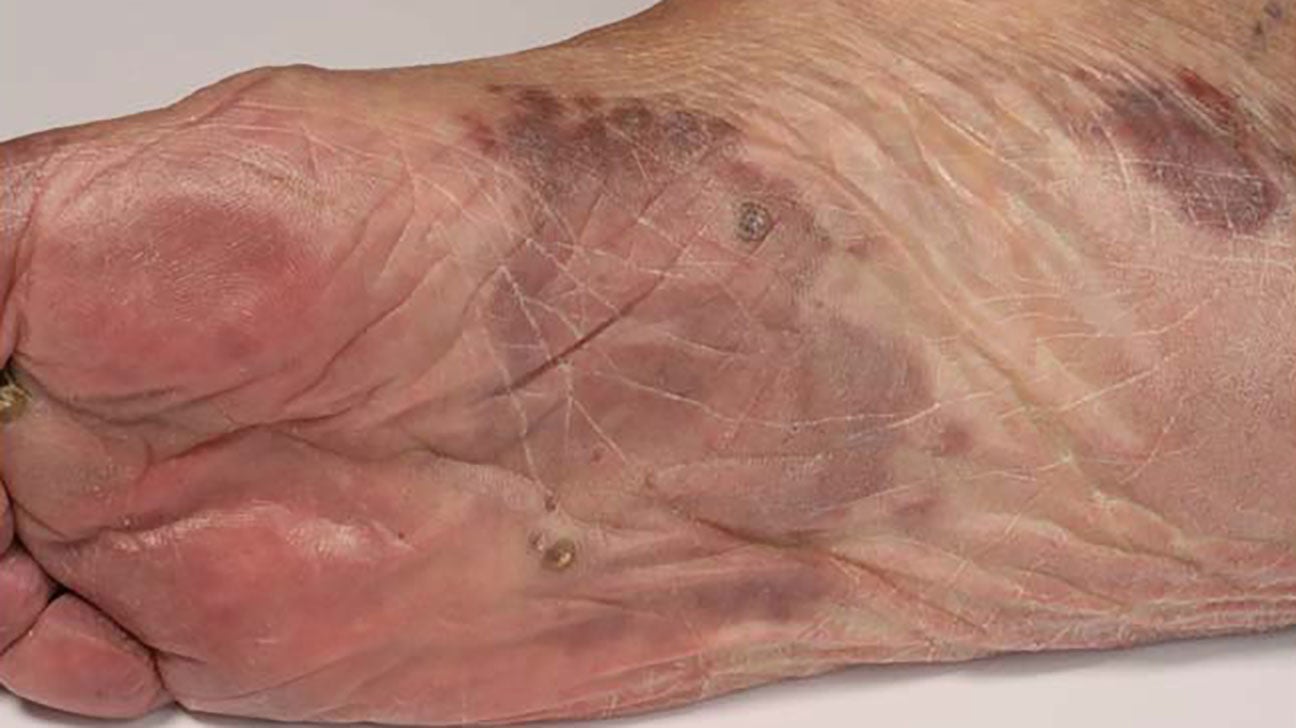 Kaposis Sarcoma Signs Symptoms And Complications 56 Off