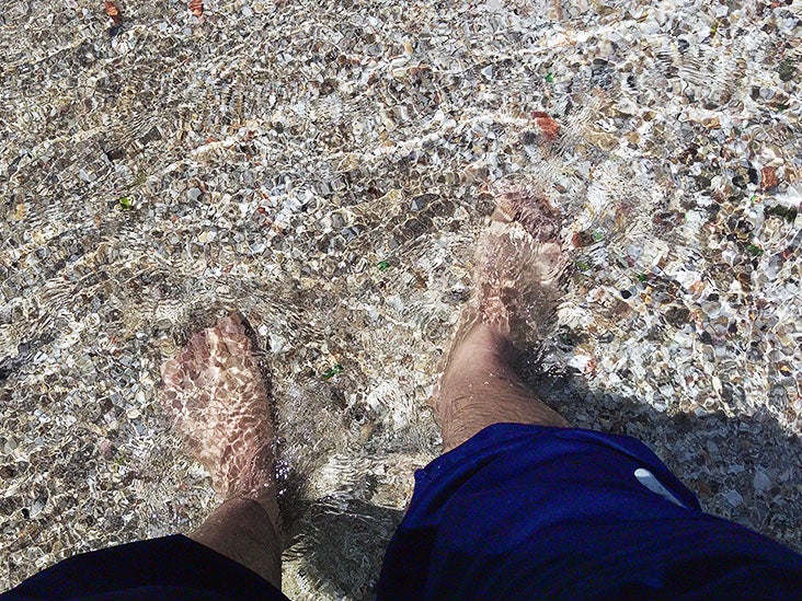 Kaposi sarcoma: Can lesions appear on the feet?