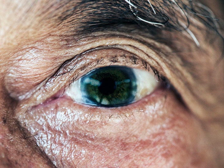 Macular Degeneration Warning Signs What They Look Like And Symptoms