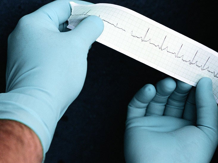 Ventricular fibrillation: Treatment, causes, and symptoms