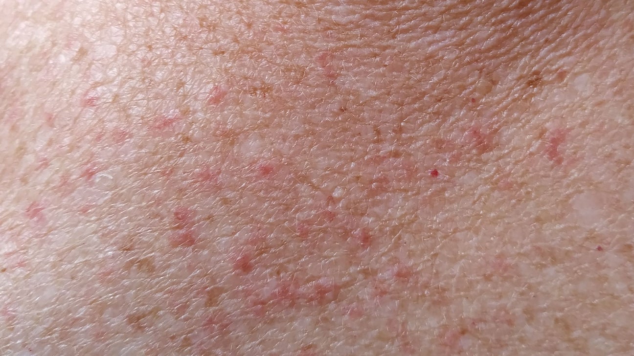 Sars Rash