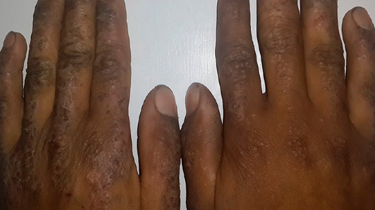 Dyshidrotic Eczema Arms