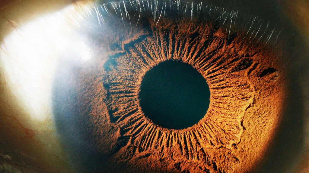 What is nonproliferative diabetic retinopathy?