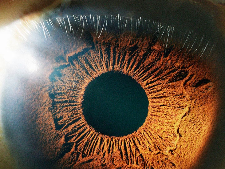 What is nonproliferative diabetic retinopathy?