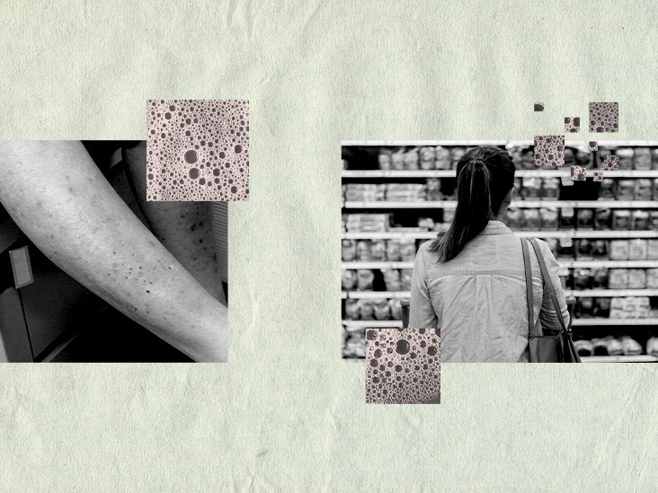 Celiac Rash What It Looks Like Symptoms And Triggers
