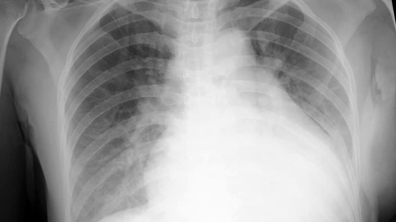 Pulmonary Veins Xray Pulmonary Veins Xray