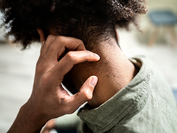 Kidney Disease Can It Cause Itchy Skin And Rashes 
