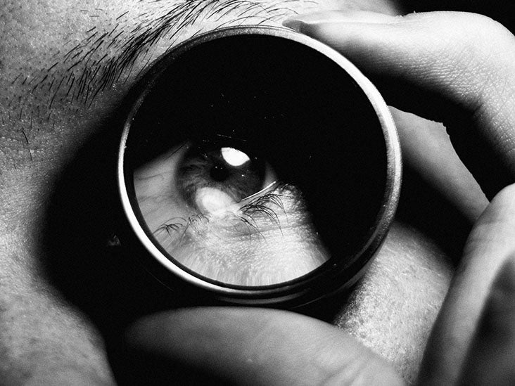 Cataracts: What do they look like?