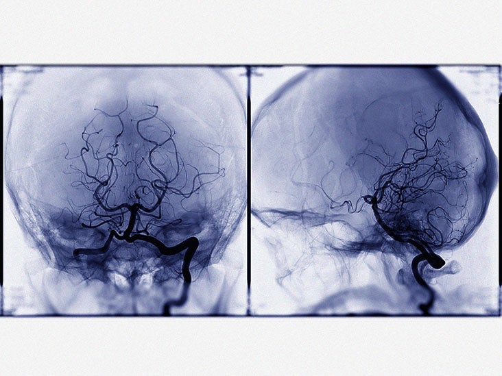 What Can Cause A Brain Aneurysm To Rupture What Can Cause A Brain Aneurysm To Rupture