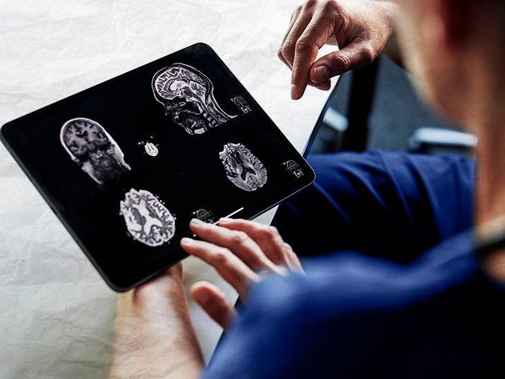 Basilar artery stroke: Symptoms, treatment, and outcome