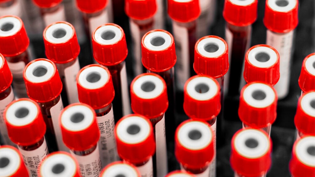 Heart disease risk: Protein test more accurate than cholesterol