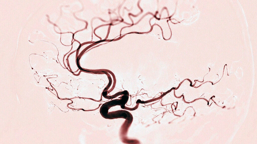 Stroke affecting the middle cerebral artery: Symptoms and more