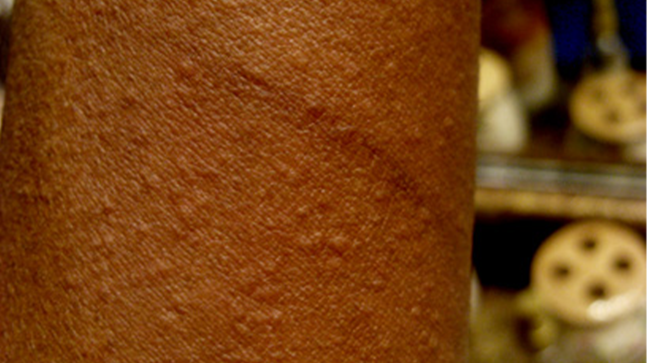 Cholinergic Urticaria Face