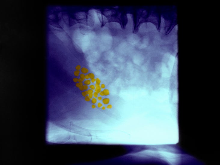 Gallstone sizes and shapes: What to expect and more