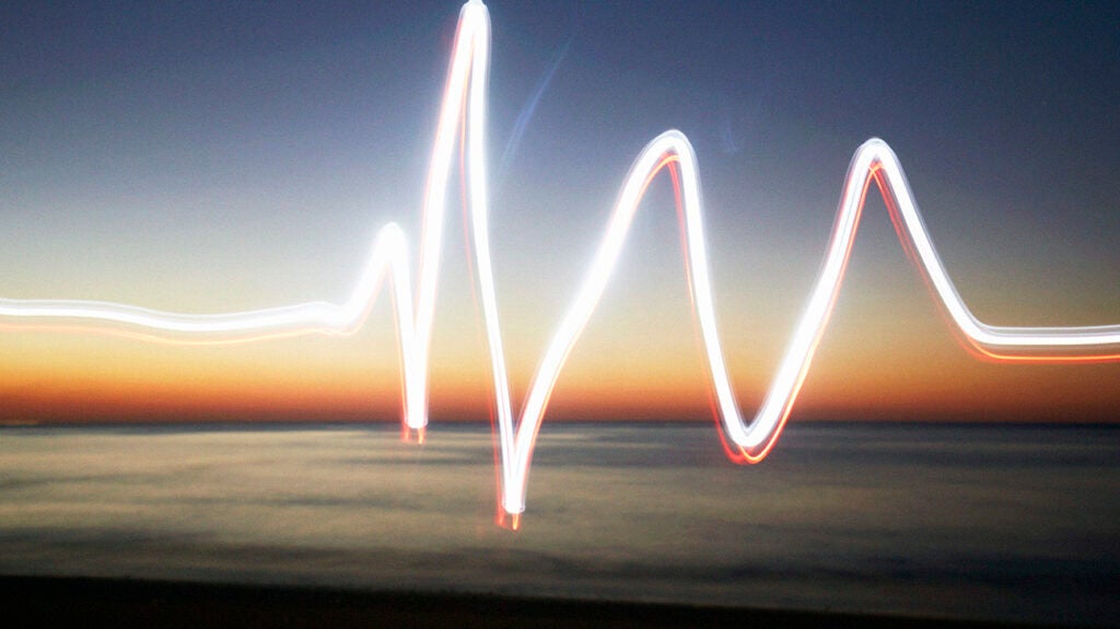 Atrial fibrillation linked to a 13% higher risk of dementia