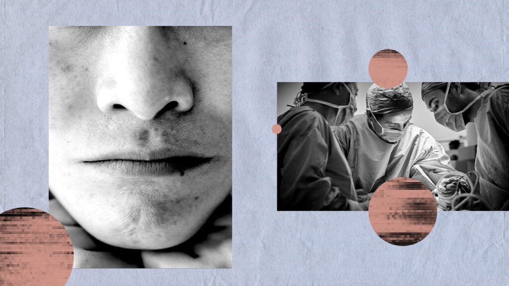Plastic surgery for acne scars: Can they be helpful?