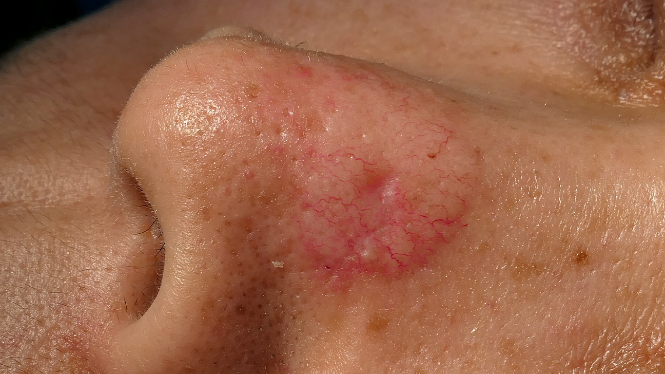 Skin Cancer On Face Images Vrogue co Skin Cancer On Face Images Vrogue co