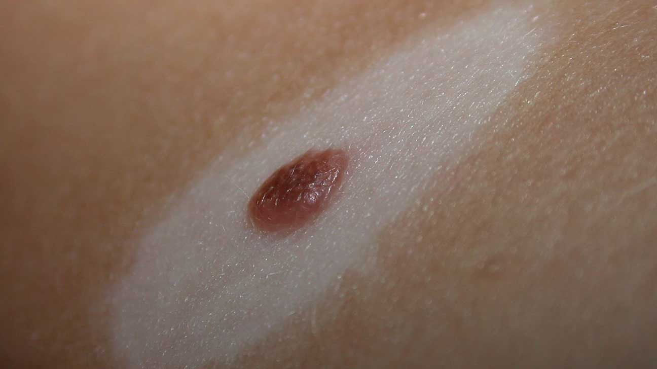 White Mole On Face