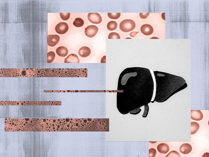 Anemia And Cirrhosis Possible Links And More