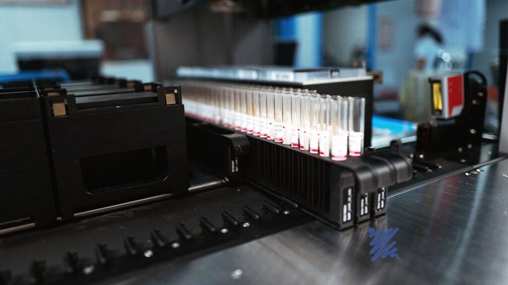 Anemia in chronic kidney disease (CKD): Symptoms, treatment