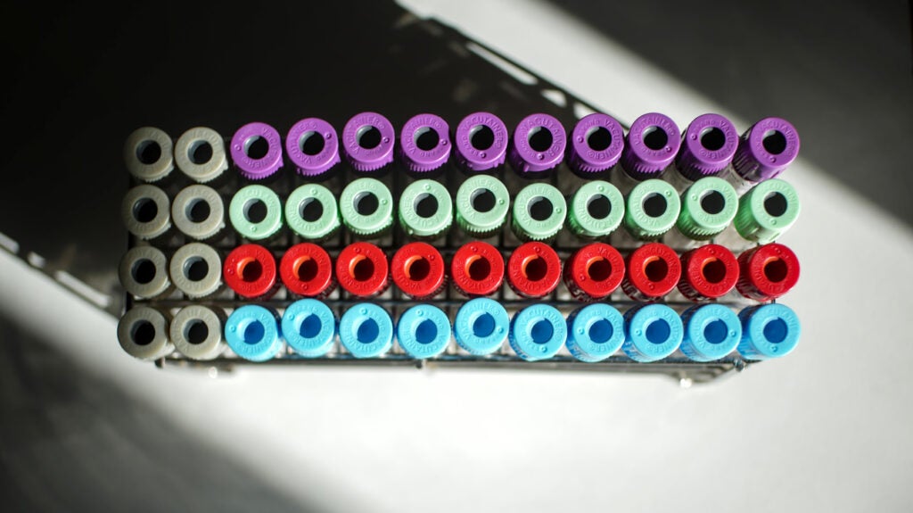 Anemia: Is it dangerous and how to treat it