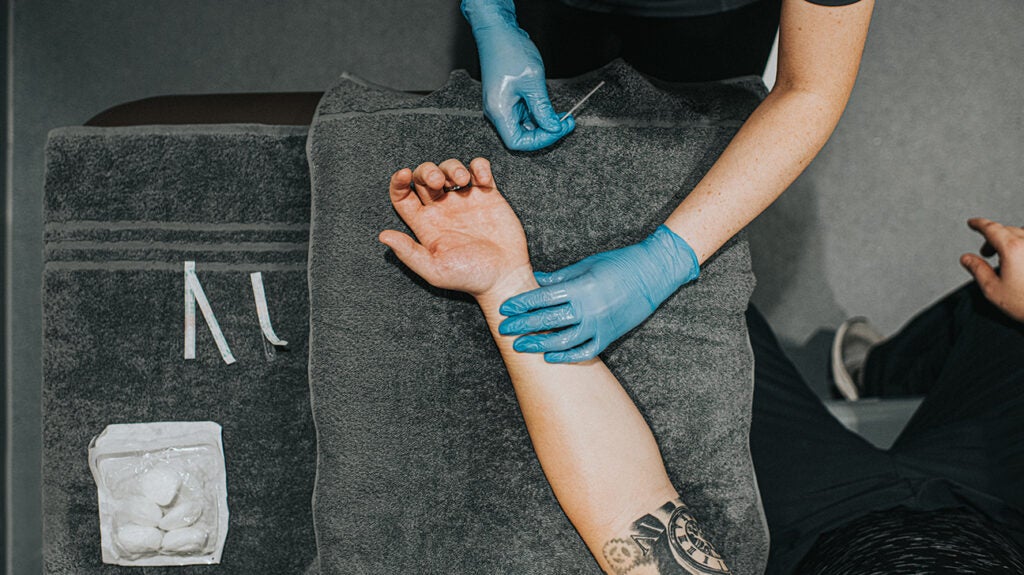 Acupuncture and constipation: Can it help?