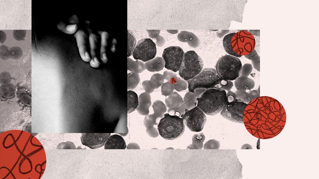 ALL leukemia in adults: Symptoms, causes, treatments