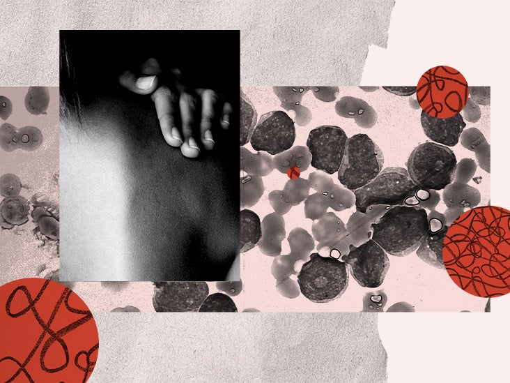 ALL leukemia in adults: Symptoms, causes, treatments