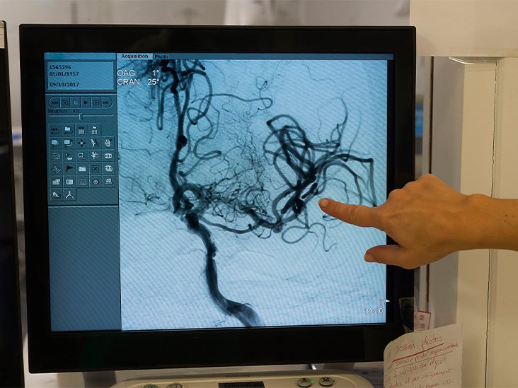 What are the different types of blood clots?