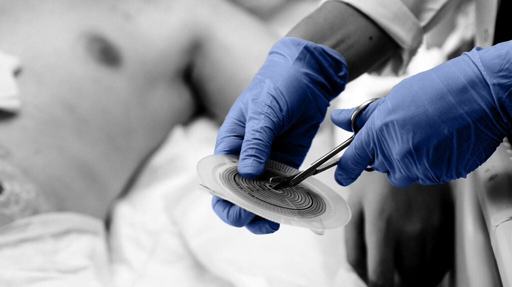 What Is The Expected Output For An Ileostomy Typical Vs High