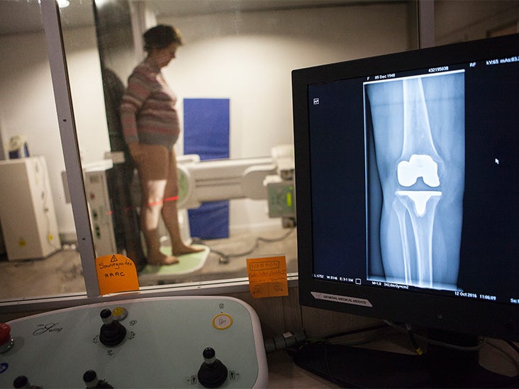 Artificial knee: What it is, how long it lasts, and the risks