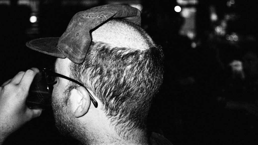 Baldness breakthrough? New RNA treatment may stimulate hair growth