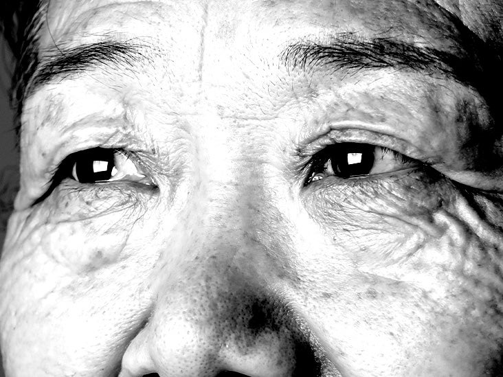 Cataracts: Symptoms, types, causes, and treatments