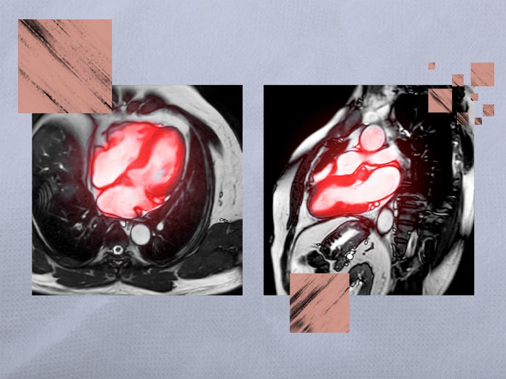 Heart MRI Scans Who May Need One What To Expect And More