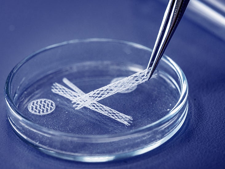 Do stents need to be replaced? Explaining restenosis