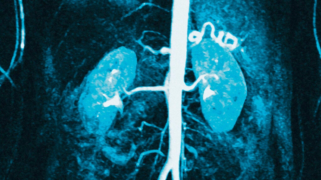 What to know about diabetic nephropathy hyperkalemia