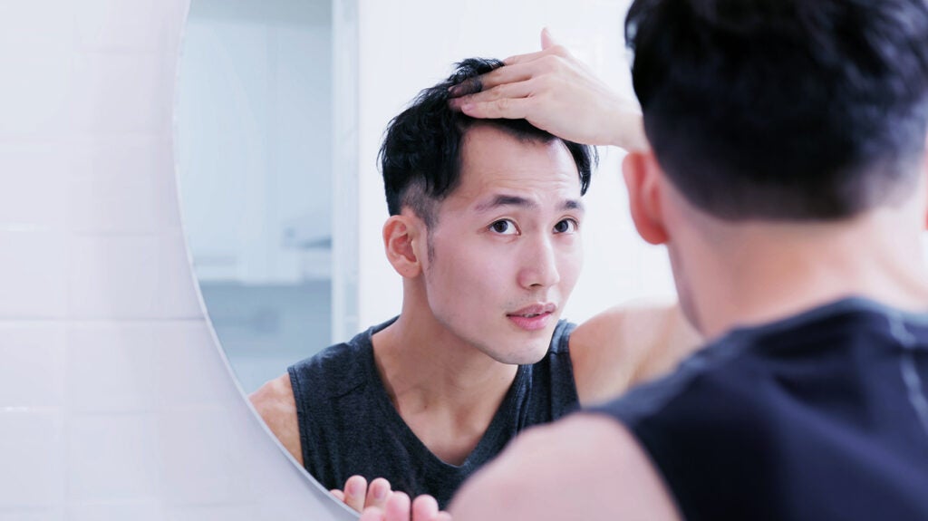 Receding hairline: Treatment, stages, and causes