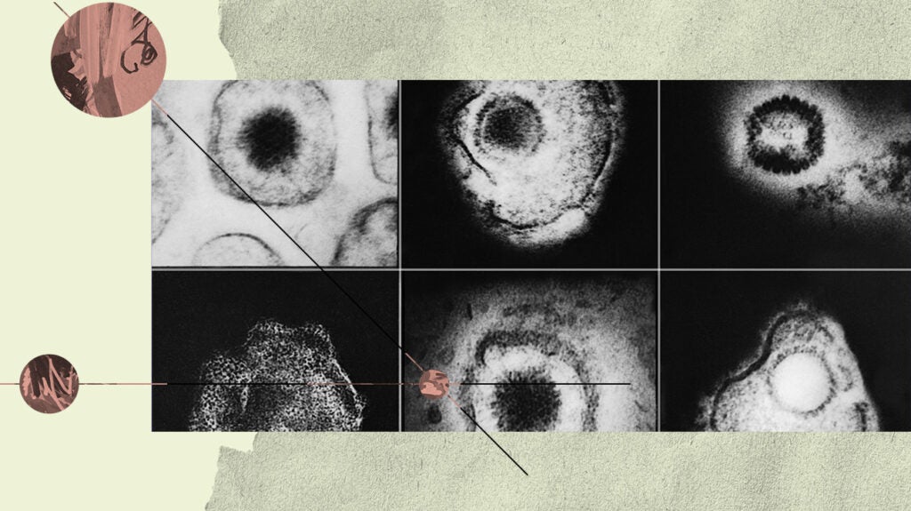 Melanoma treatment: Is a genetically altered herpes virus the answer?