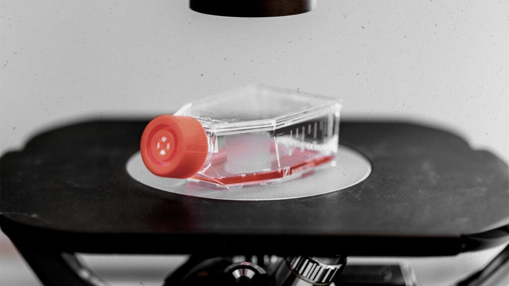 Alzheimer's: Could a two-step test improve diagnostic accuracy?