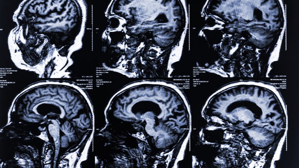 Multiple system atrophy: Symptoms and treatment