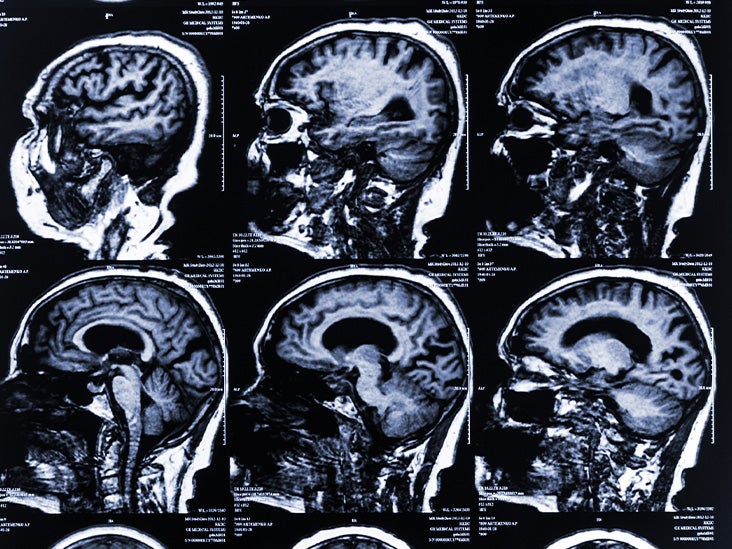Multiple system atrophy: Symptoms and treatment