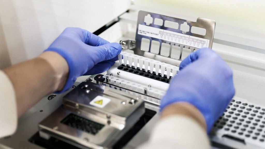 Male pattern hair loss may be linked to 5 gene variants