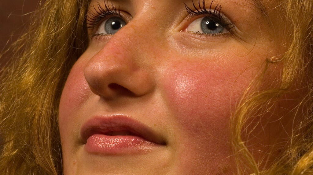 Flushed skin: Causes, pictures, and when to see a doctor