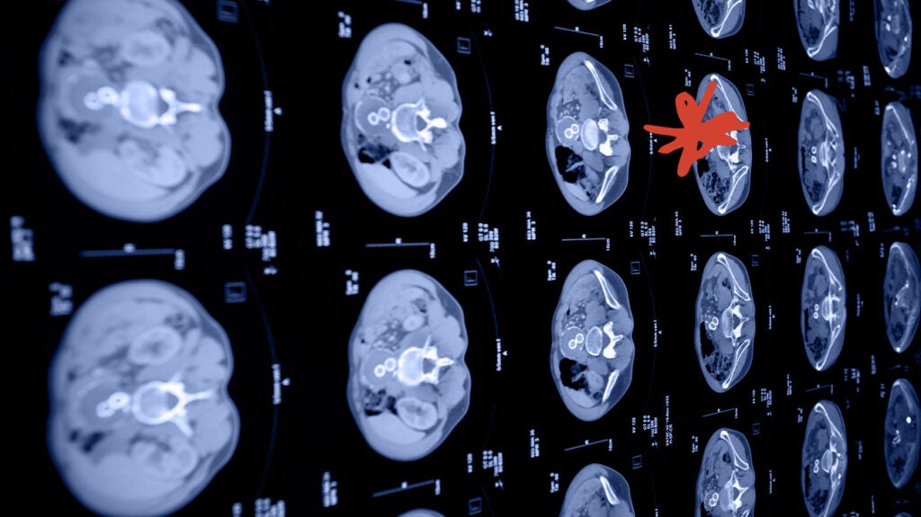 Acute vs. chronic renal failure: Differences explained