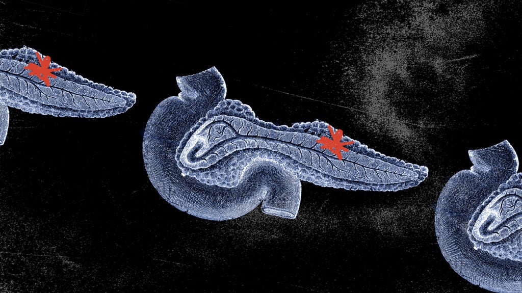 Exocrine pancreatic insufficiency: Symptoms, diagnosis, and more